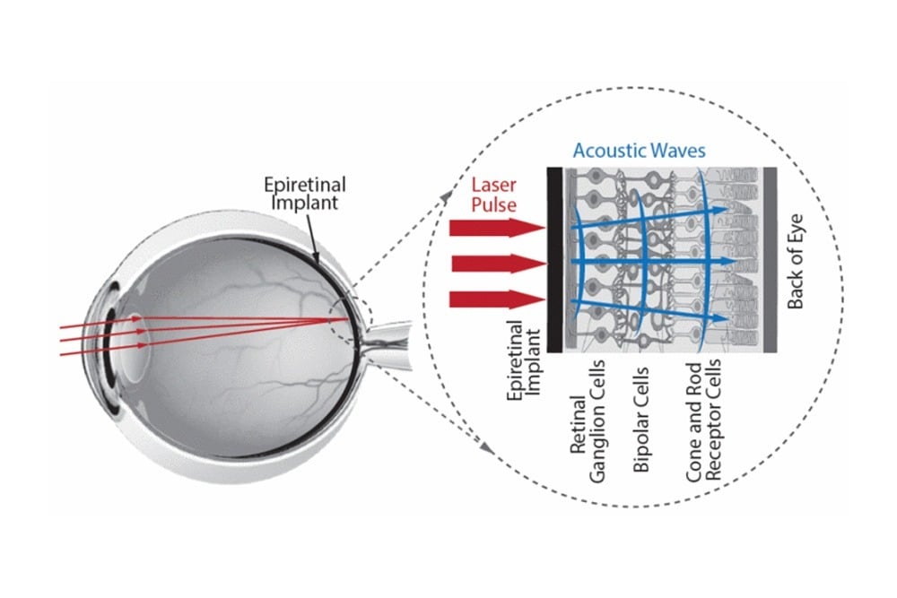 New Nanomaterial for Retinal Implants Could Someday Help Restore Sight ... New Nanomaterial for Retinal Implants Could Someday Help Restore Sight ...